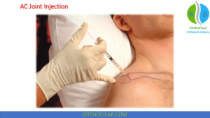 AC Joint Injection Easily Step-By-Step | OrthoFixar