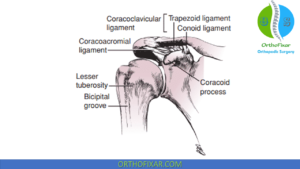 AC Joint Separation - Easy Explained | OrthoFixar 2025