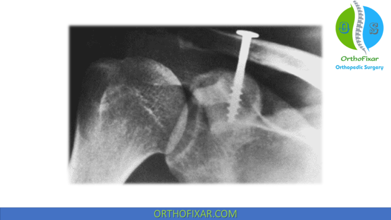 AC Joint Separation - Easy Explained | OrthoFixar 2026