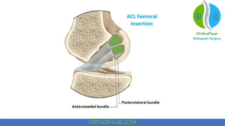ACL Injury - Easy Explained | OrthoFixar 2025