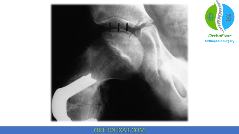 Osteonecrosis Of The Hip - Easy Explained | OrthoFixar 2026