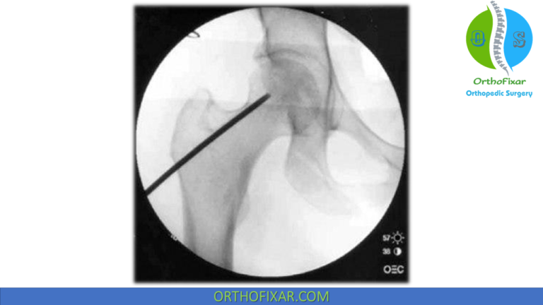 Osteonecrosis Of The Hip - Easy Explained | OrthoFixar 2025
