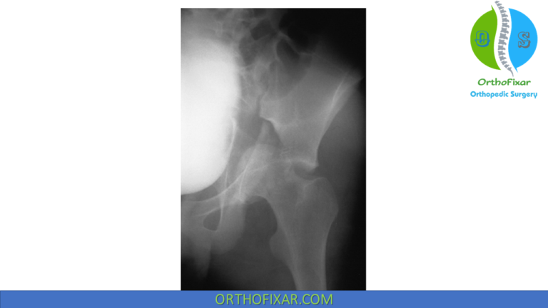 Acetabulum Fracture Full Explained | OrthoFixar 2025