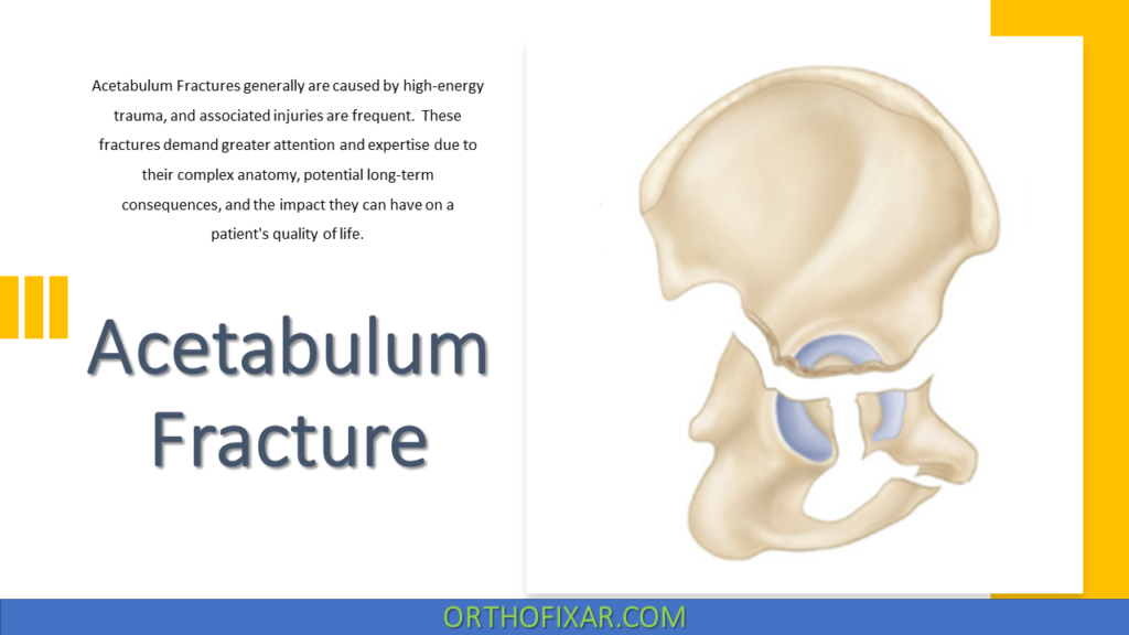 Acetabulum Fracture Full Explained | OrthoFixar 2025