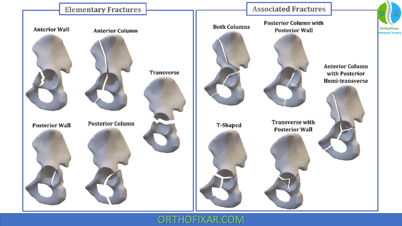 Acetabulum Fracture Full Explained | OrthoFixar 2025