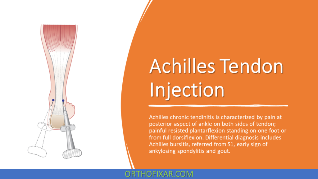 Achilles Tendon Injection Easily Step-By-Step | OrthoFixar