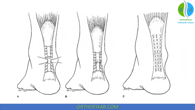 Achilles Tendon Repair Technique Easily Step-By-Step | OrthoFixar