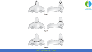 Odontoid Fracture | Orthopedic Learning