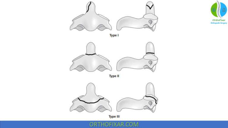 Odontoid Fracture | OrthoFixar