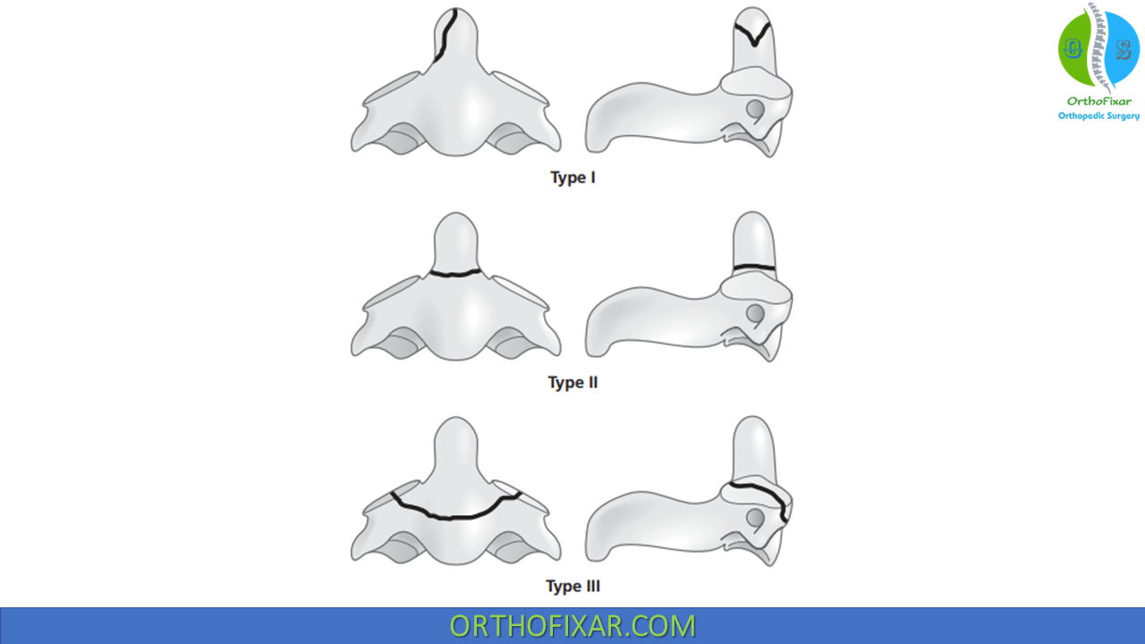 Odontoid Fracture | OrthoFixar