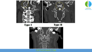 Occipital Condyle Fractures | Orthopedic Learning