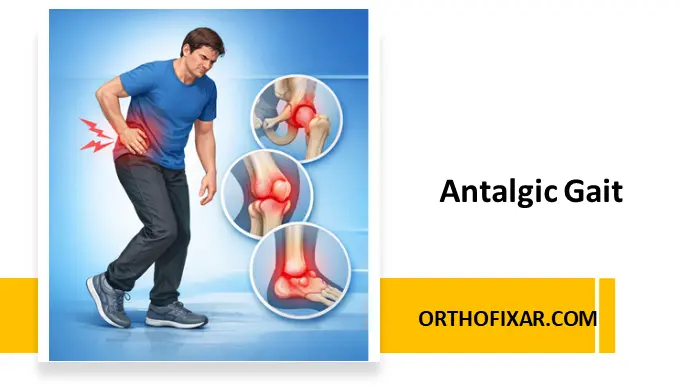 Antalgic Gait (Painful Gait) | OrthoFixar