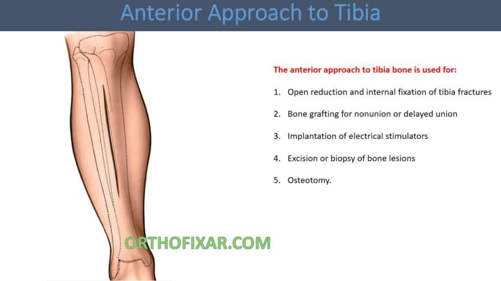 Anterior Approach To Tibia Easily Explained | OrthoFixar