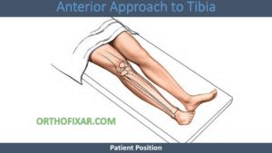 Anterior Approach To Tibia
