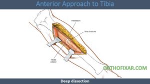 Anterior Approach To Tibia