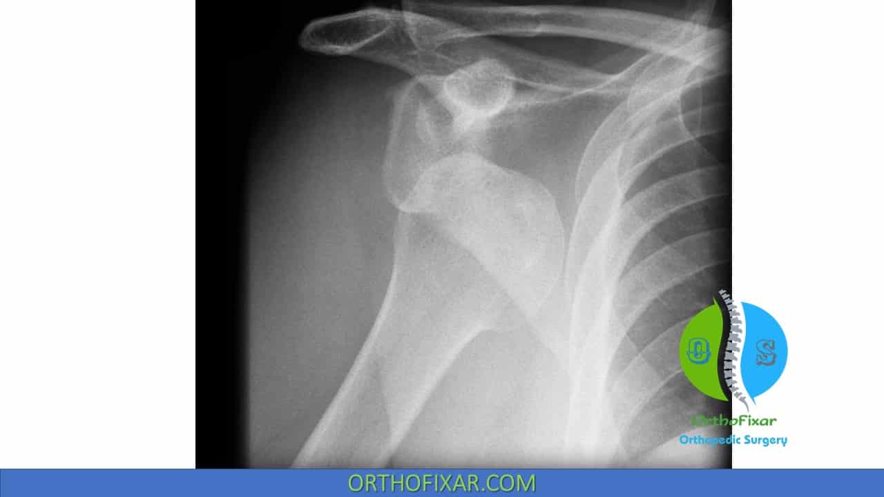 Shoulder Anterior Drawer Test 2025