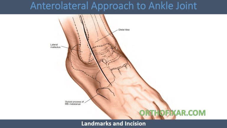Anterolateral Approach To Ankle Joint • Full & Easy • OrthoFixar 2026