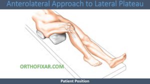Anterolateral Approach To Lateral Plateau