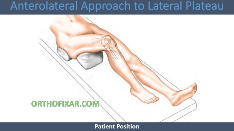 Anterolateral Approach To Lateral Plateau Easily Explained | OrthoFixar