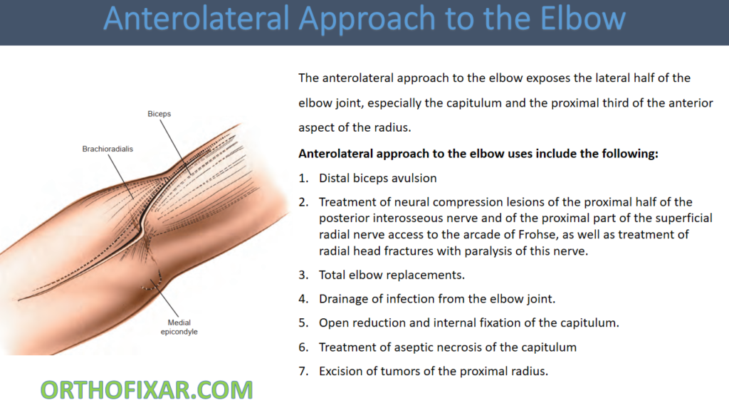 Anterolateral Approach To The Elbow Easily Explained | OrthoFixar