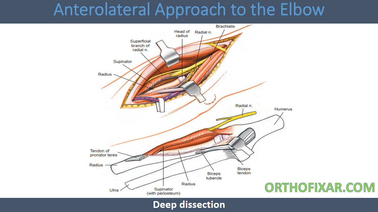Anterolateral Approach To The Elbow