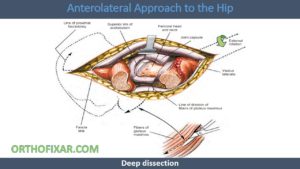Anterolateral Approach To Hip Joint • Easy Explained • OrthoFixar 2026