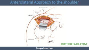 Anterolateral Approach To The Shoulder Easily Explained | OrthoFixar
