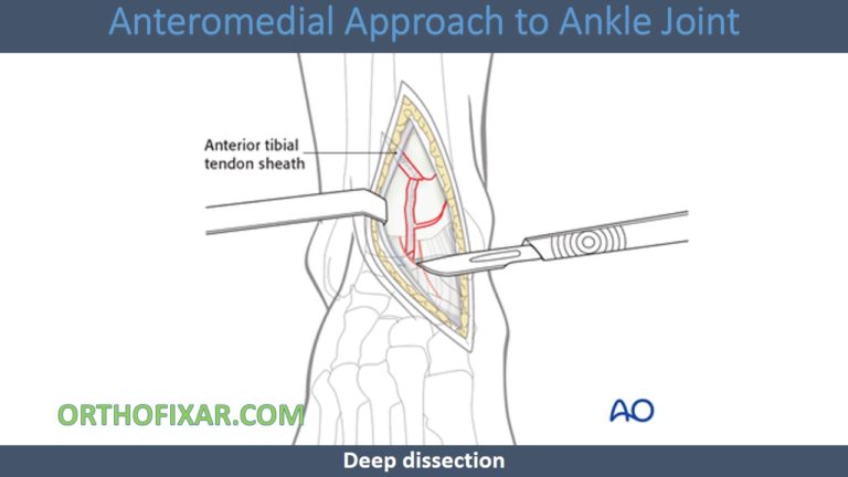 Anteromedial Approach To Ankle Joint Easily Explained | OrthoFixar