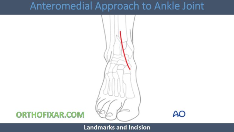 Anteromedial Approach To Ankle Joint
