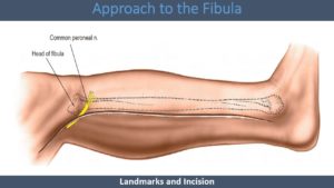 Approach To The Fibula • Easy Tutorial • OrthoFixar 2025
