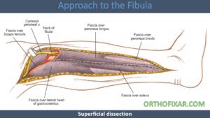 Approach To The Fibula • Easy Tutorial • OrthoFixar 2025
