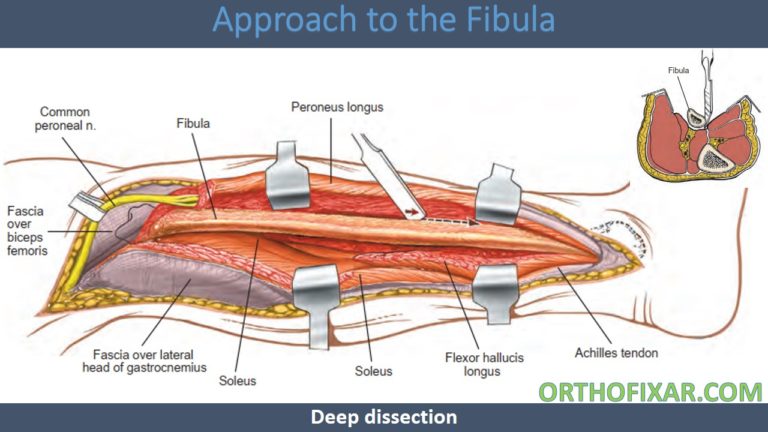 Approach To The Fibula • Easy Tutorial • OrthoFixar 2025