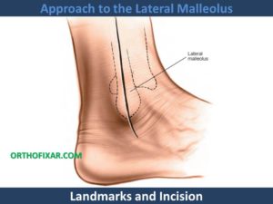 Approach To The Lateral Malleolus • OrthoFixar 2026