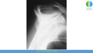 Shoulder X-ray Views | OrthoFixar