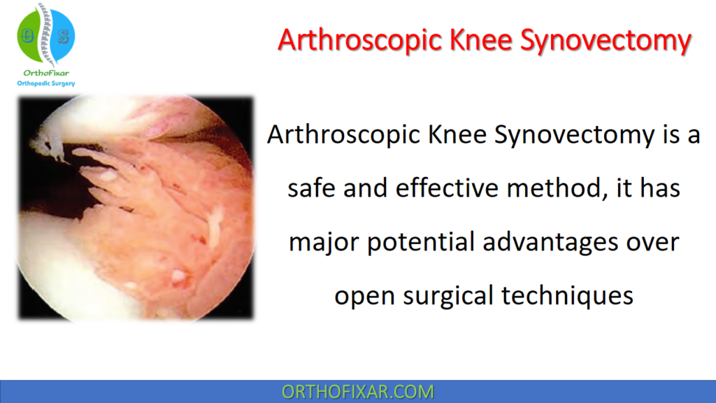Arthroscopic Knee Synovectomy Easily Step-By-Step | OrthoFixar