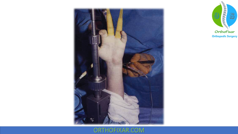 Proximal Row Carpectomy Easily Step-By-Step | OrthoFixar