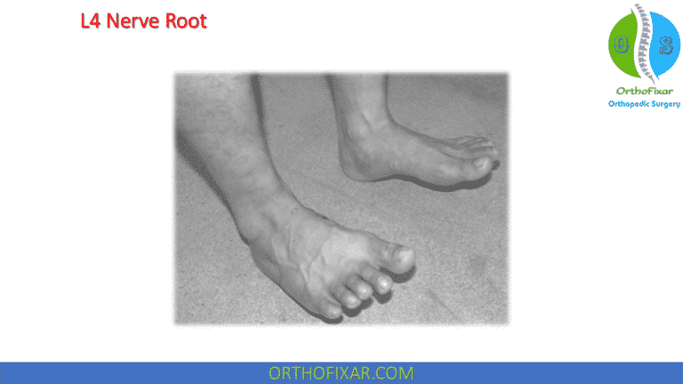 Lumbar Spine Nerve Roots