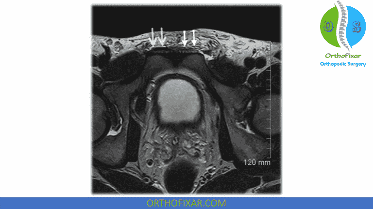 Sports Hernia (Athletic Pubalgia) | OrthoFixar 2026