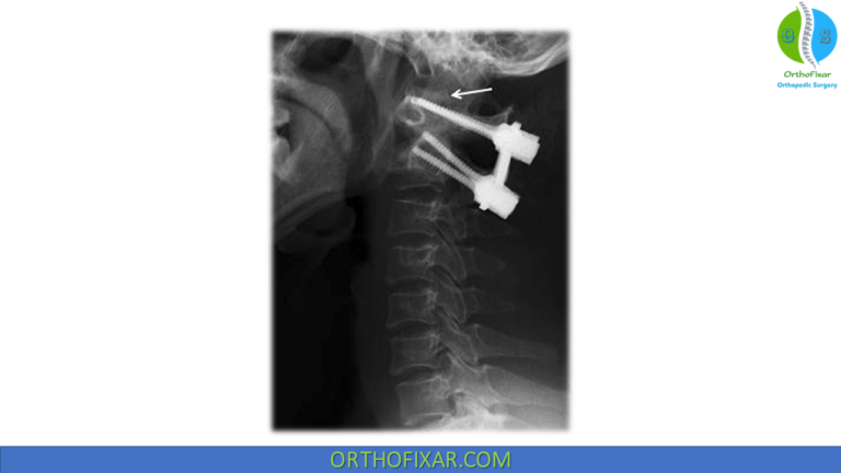 Atlas Fracture Overview | Orthopedic Learning