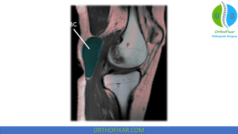 Baker's Cyst Aspiration | OrthoFixar 2026