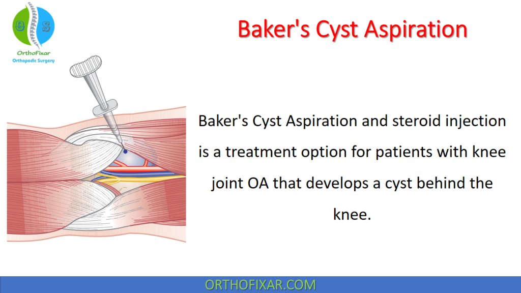 Baker's Cyst Aspiration | OrthoFixar 2025