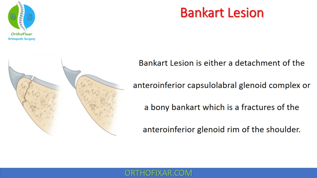 Bankart Lesion 2026 | Shoulder Dislocation