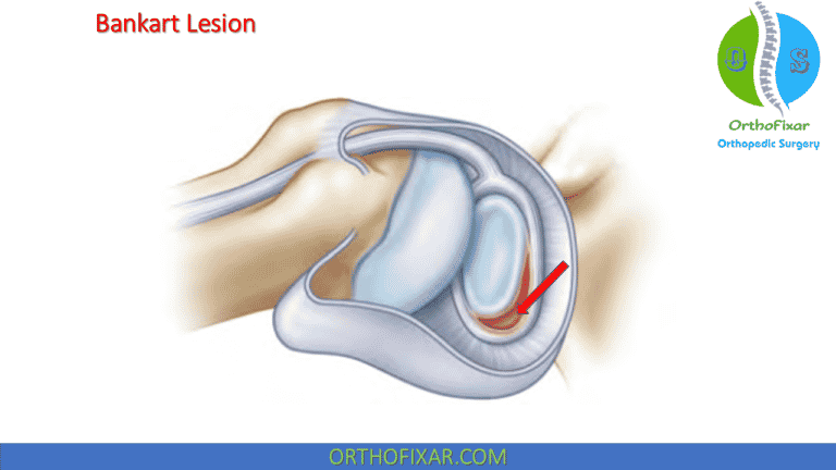 Bankart Lesion 2025 | Shoulder Dislocation