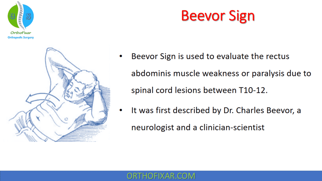 Beevor Sign Explained Easily | OrthoFixar