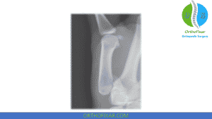 Bennett Fracture Overview | OrthoFixar