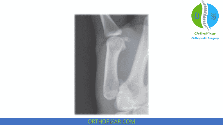Bennett Fracture Overview | OrthoFixar