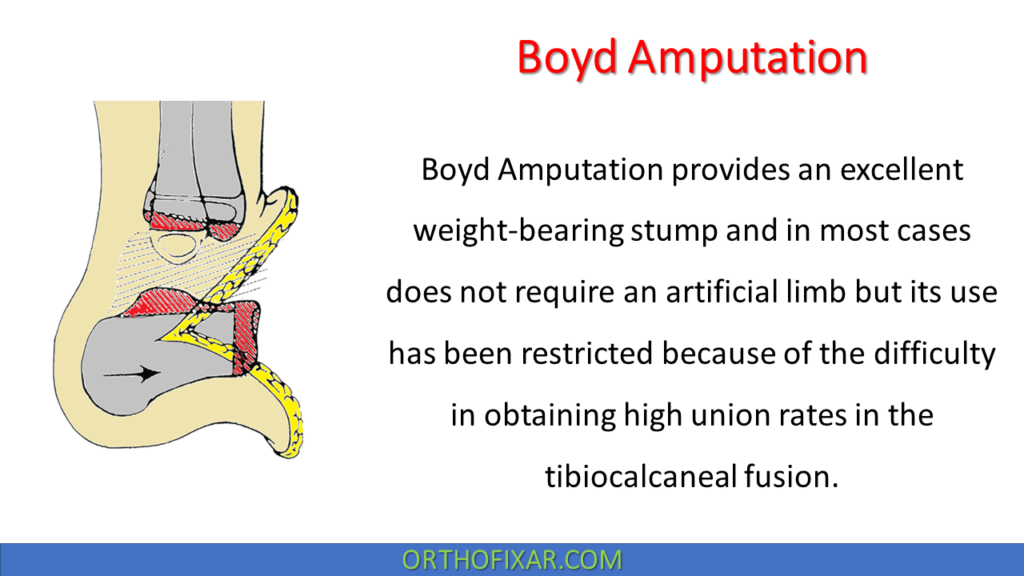 Boyd Amputation Easily Step-By-Step | OrthoFixar