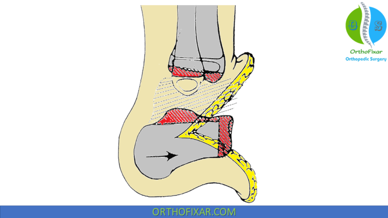 Boyd Amputation Easily Step-By-Step | OrthoFixar