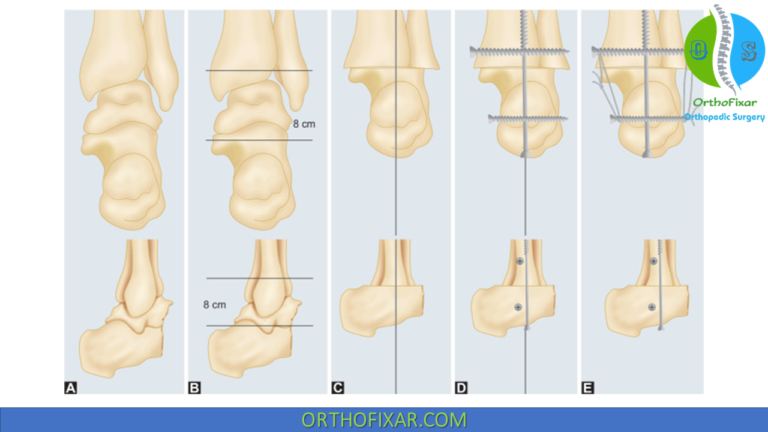Boyd Amputation Easily Step-By-Step | OrthoFixar