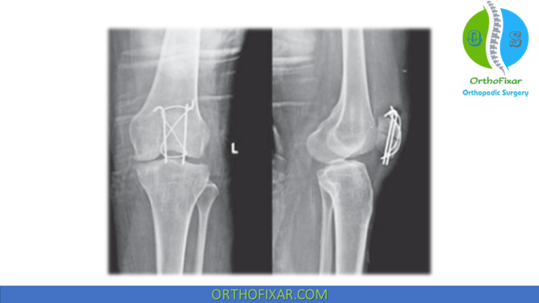Patellar Fractures | Broken Kneecap | Orthopedic Learning